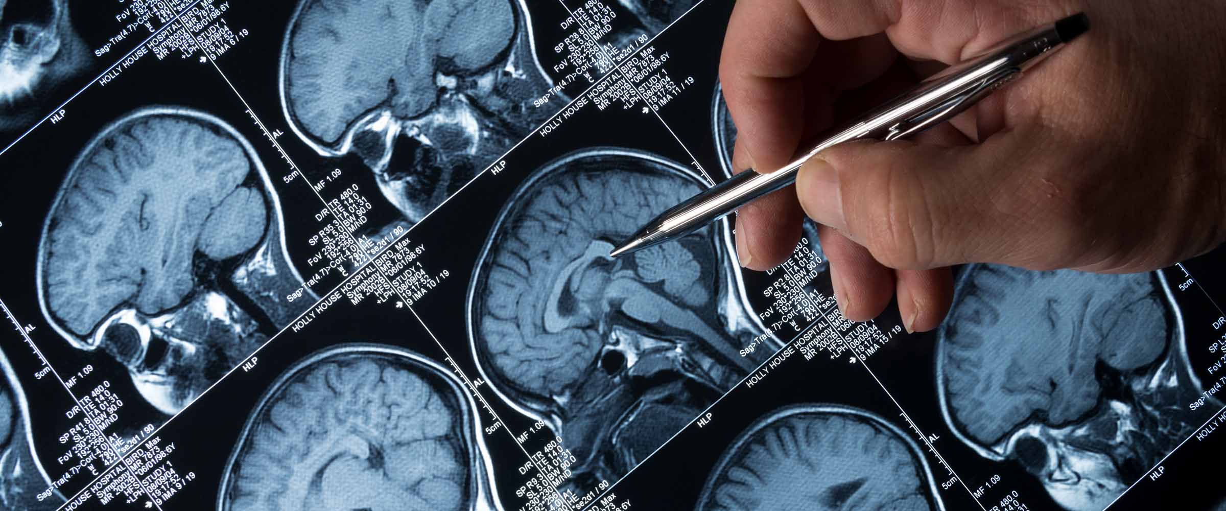 AVM Grading Systems | East Bay Brain & Spine